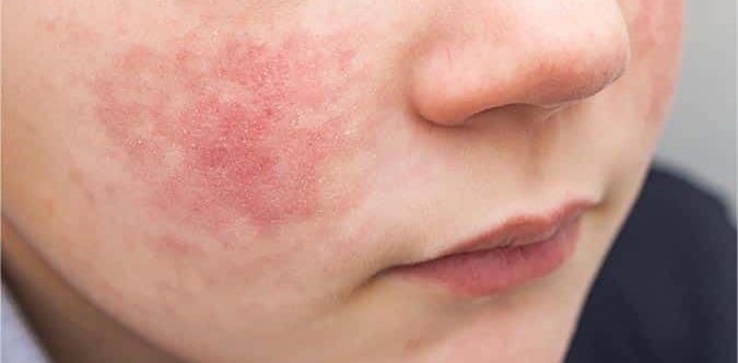 Mejillas rojas: por qué esta primavera hay un brote de un virus que ...